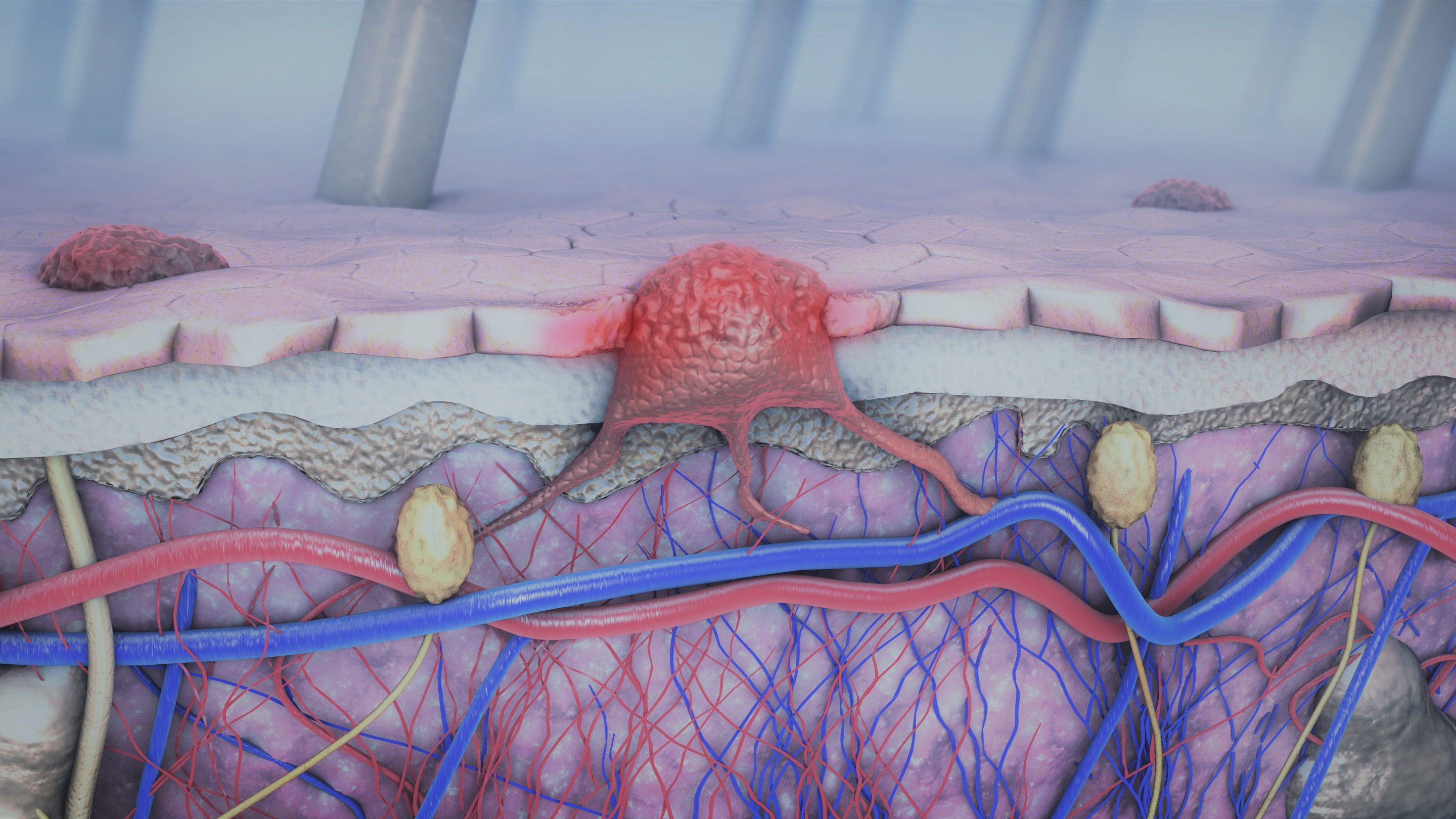 Subsidie voor belangrijk onderzoek naar huidkanker - Amazing Erasmus MC