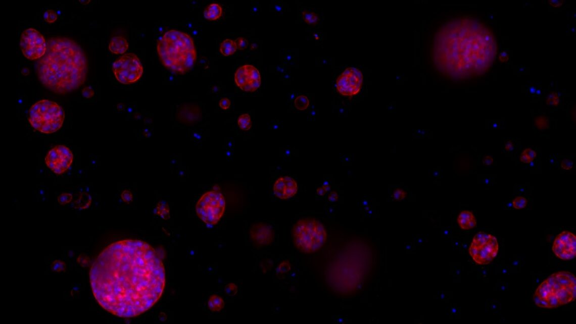 Tumor-in-a-dish moet voorspellen of blaastumor gevoelig is voor ...