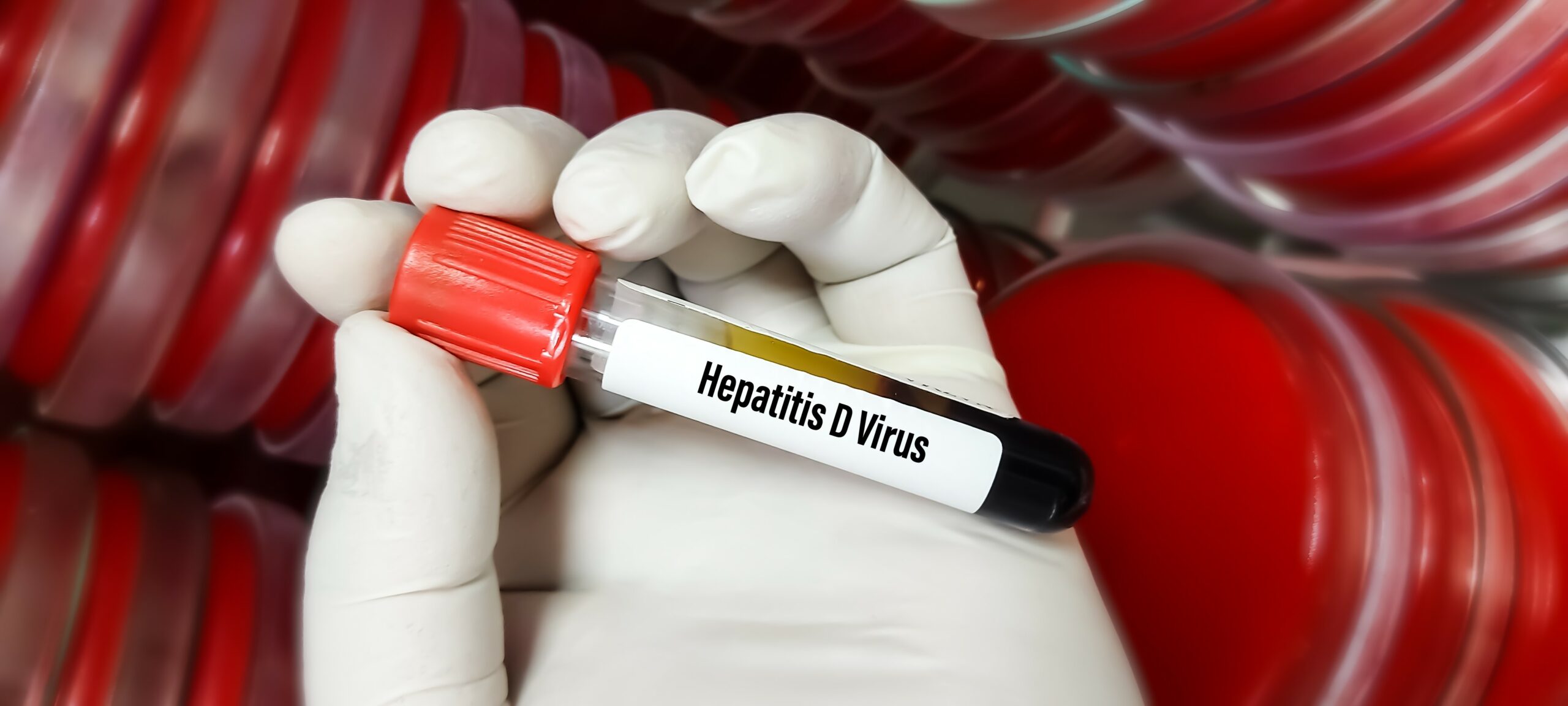 Hepatitis D: een dodelijke verstekeling zonder goede behandeling ...